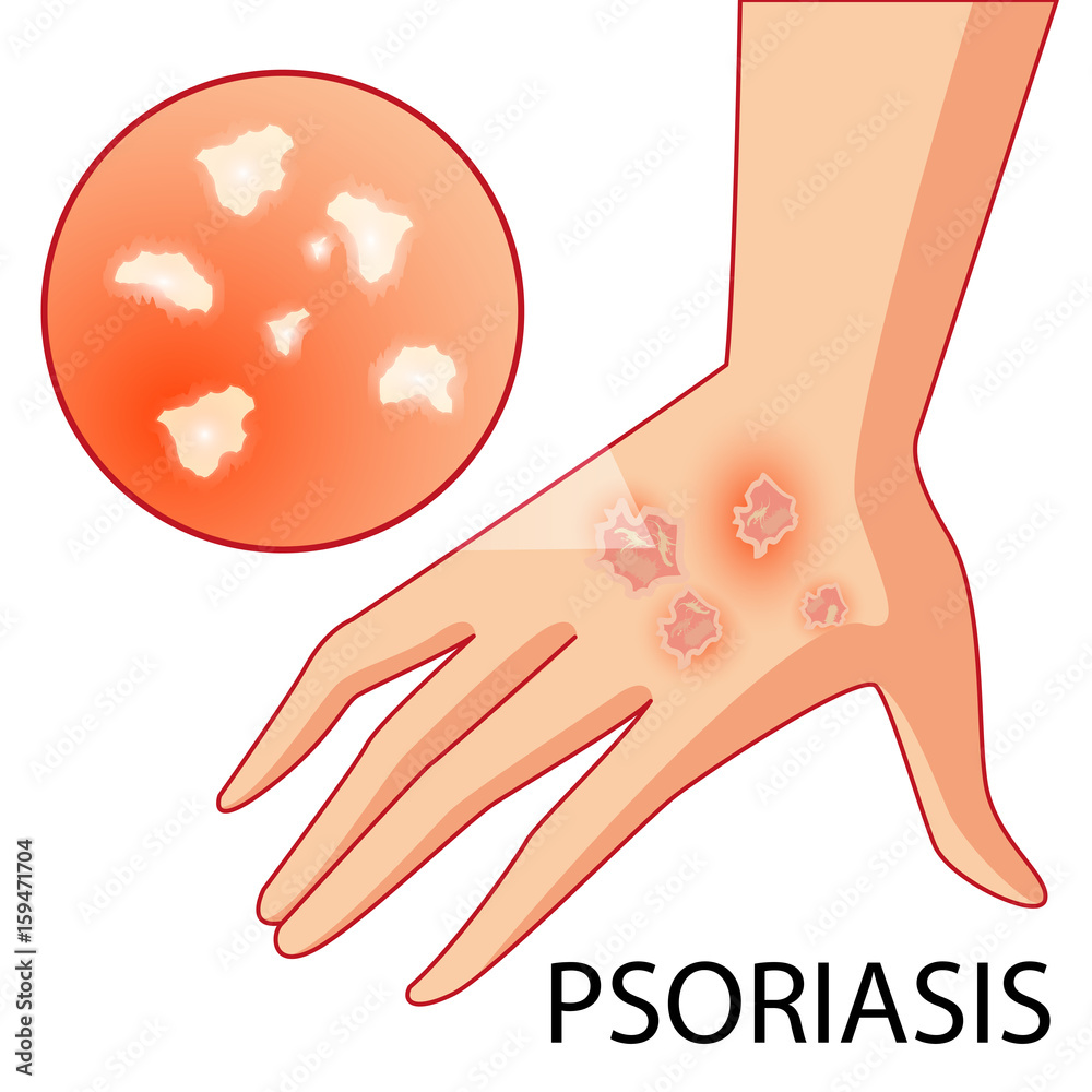 Psoriasis. Skin problems. Vector. Cartoon. Isolated. Flat. Illustration ...
