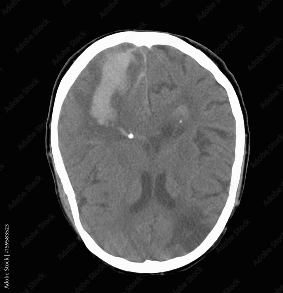 CT scan of the brain showing a stroke Stock Photo | Adobe Stock