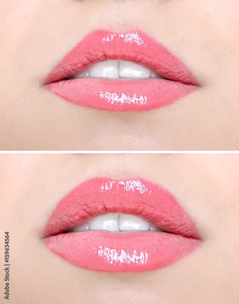 Female lips before and after augmentation procedure. Beauty concept ...