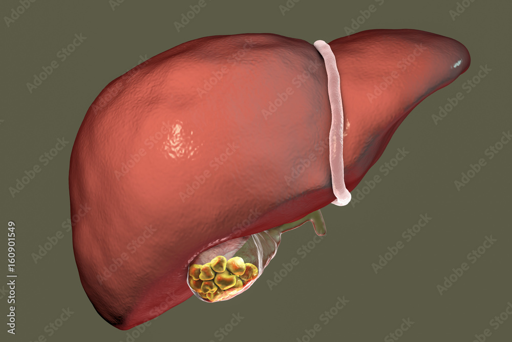 Gallstones, 3D illustration showing front view of liver and gallbladder ...