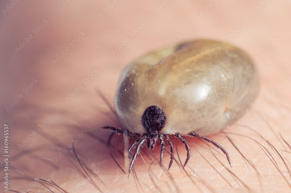 Tick filled with blood sitting on human skin Stock Photo | Adobe Stock