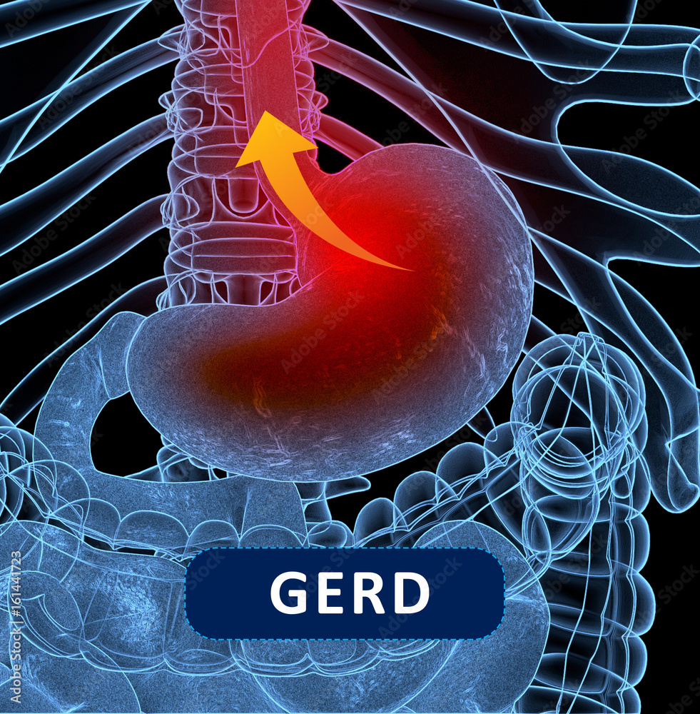 Acid Reflux Gerd Gastroesophageal Reflux Disease Diagram With Title