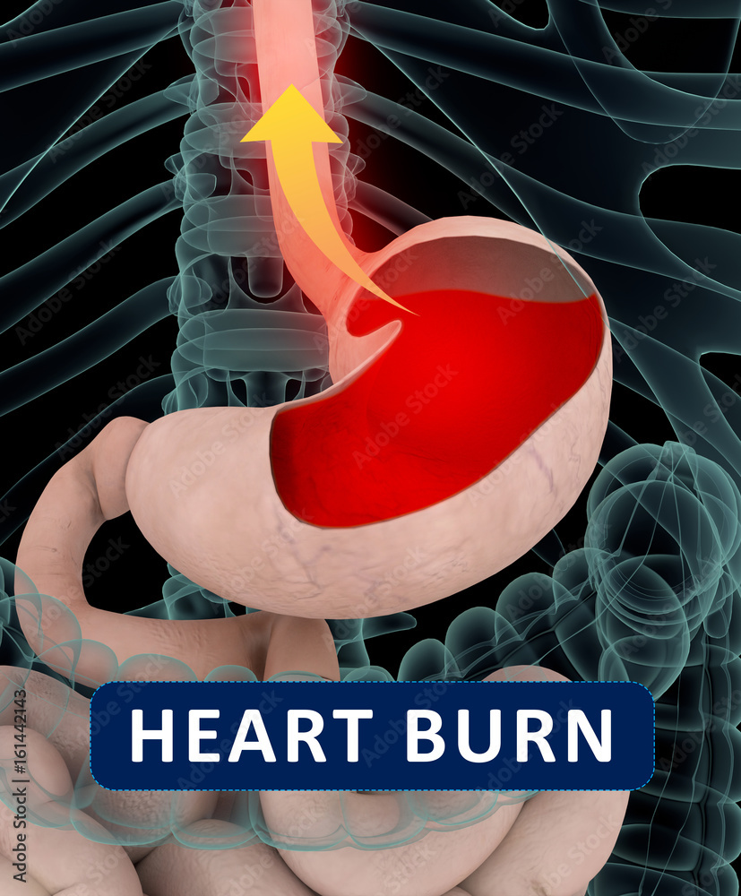 Acid reflux, GERD. Gastroesophageal reflux disease. Diagram with title ...