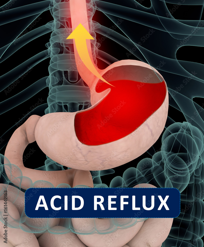 Acid Reflux Gerd Gastroesophageal Reflux Disease Diagram With Title