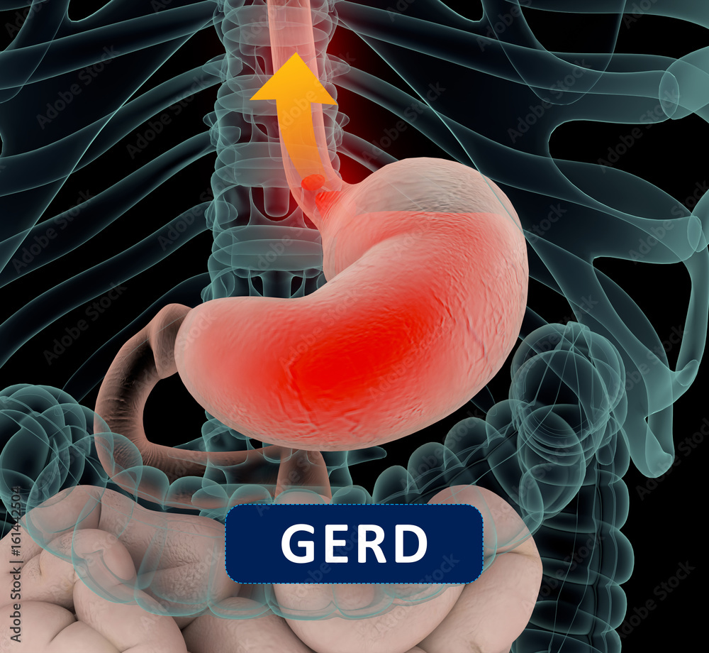 ภาพประกอบสต็อก Acid reflux, GERD. Gastroesophageal reflux disease ...