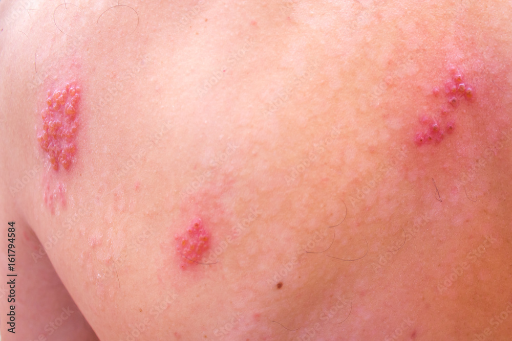 Shingles on men herpes zoster. Closeup. Stock Photo | Adobe Stock