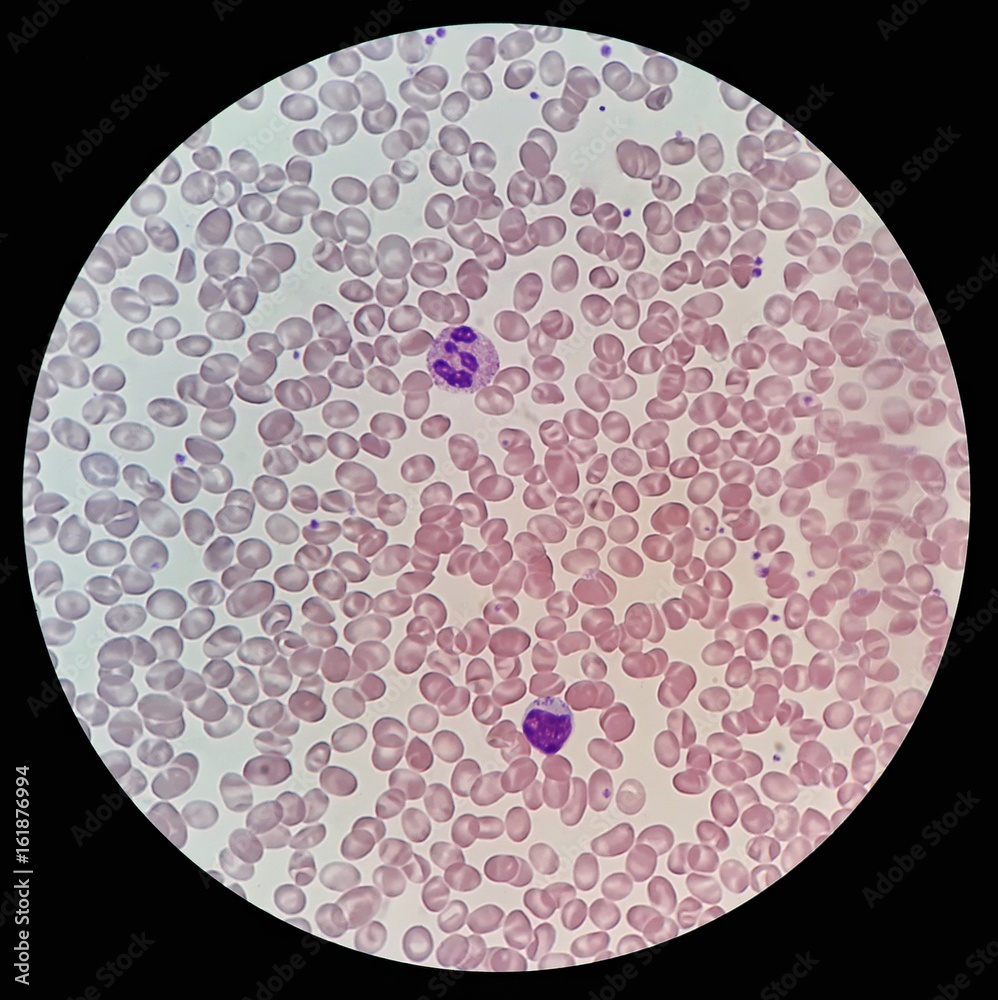 Foto Stock Human blood smear with abnormal red blood cells morphology ...