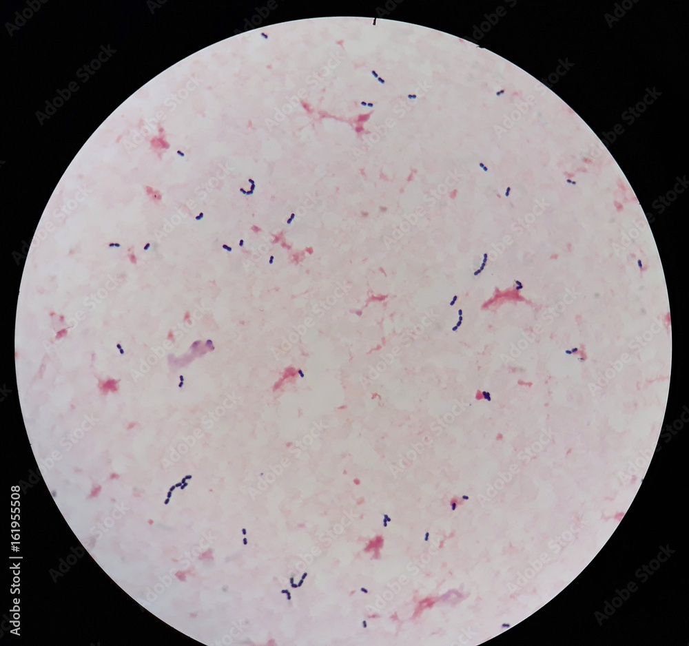 Smear of gram positive bacilli with Chinese letters shape bacteria ...