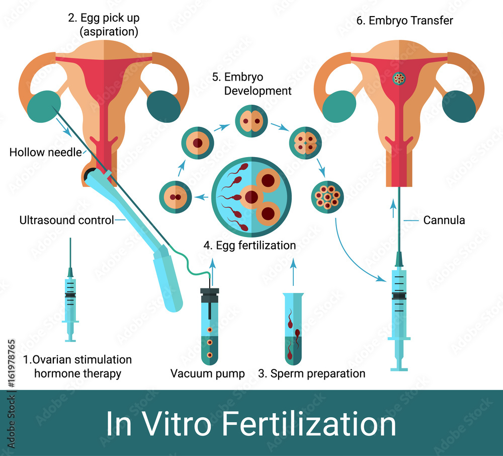 Vetor de In vitro fertilization infographic chart in flat style. Scheme ... Vetor de In vitro fertilization infographic chart in flat style. Scheme ...