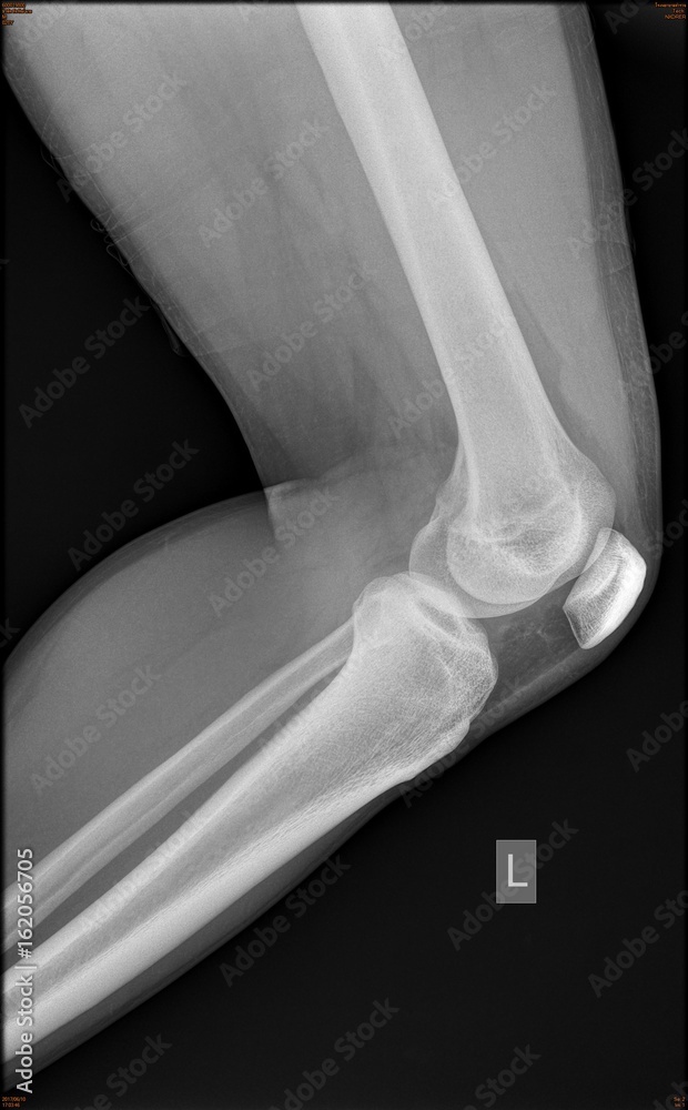 X-ray of human knee side view Stock Photo | Adobe Stock