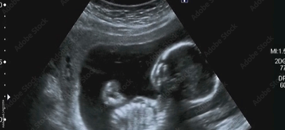 Ultrasonography Analysis of a 4th Month Fetus Stock Photo | Adobe Stock