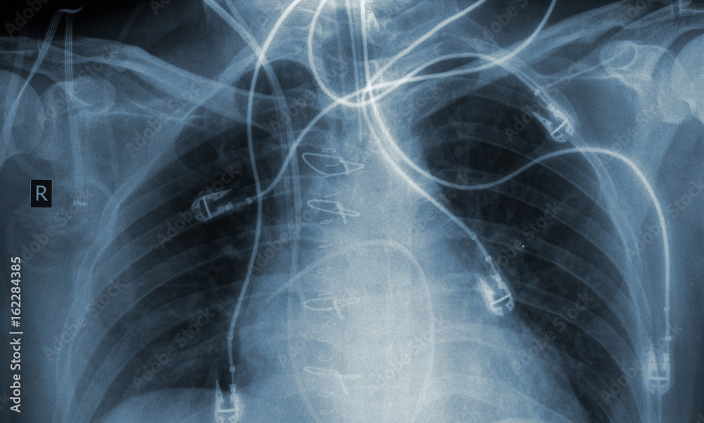 Human x-ray image of ribcage Stock Photo | Adobe Stock