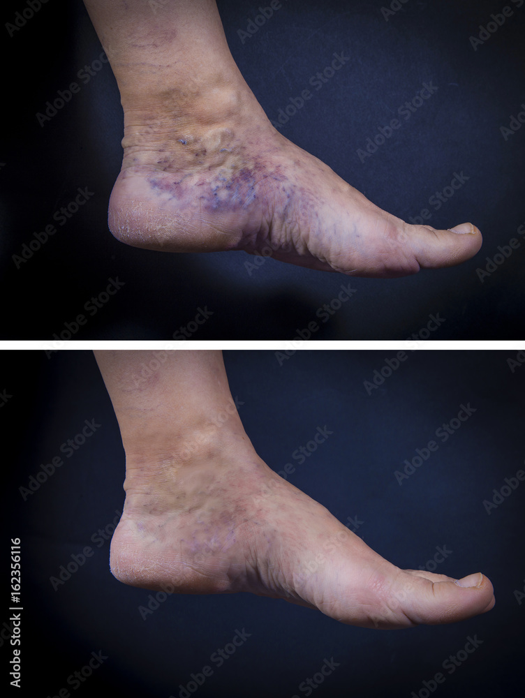 Human foot with varicose veins before and after Stock Photo | Adobe Stock