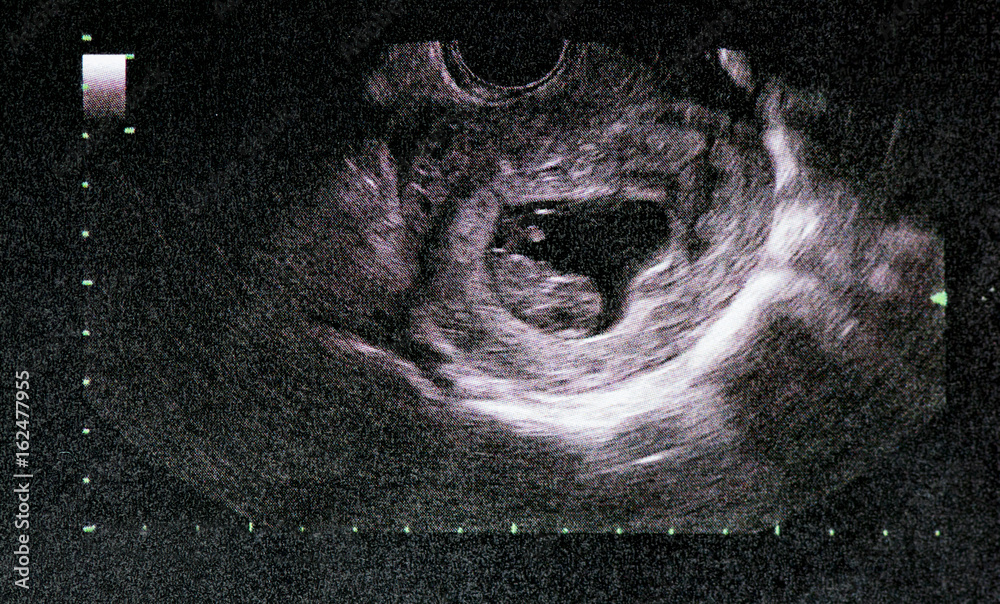 Human Fetus 14 Weeks