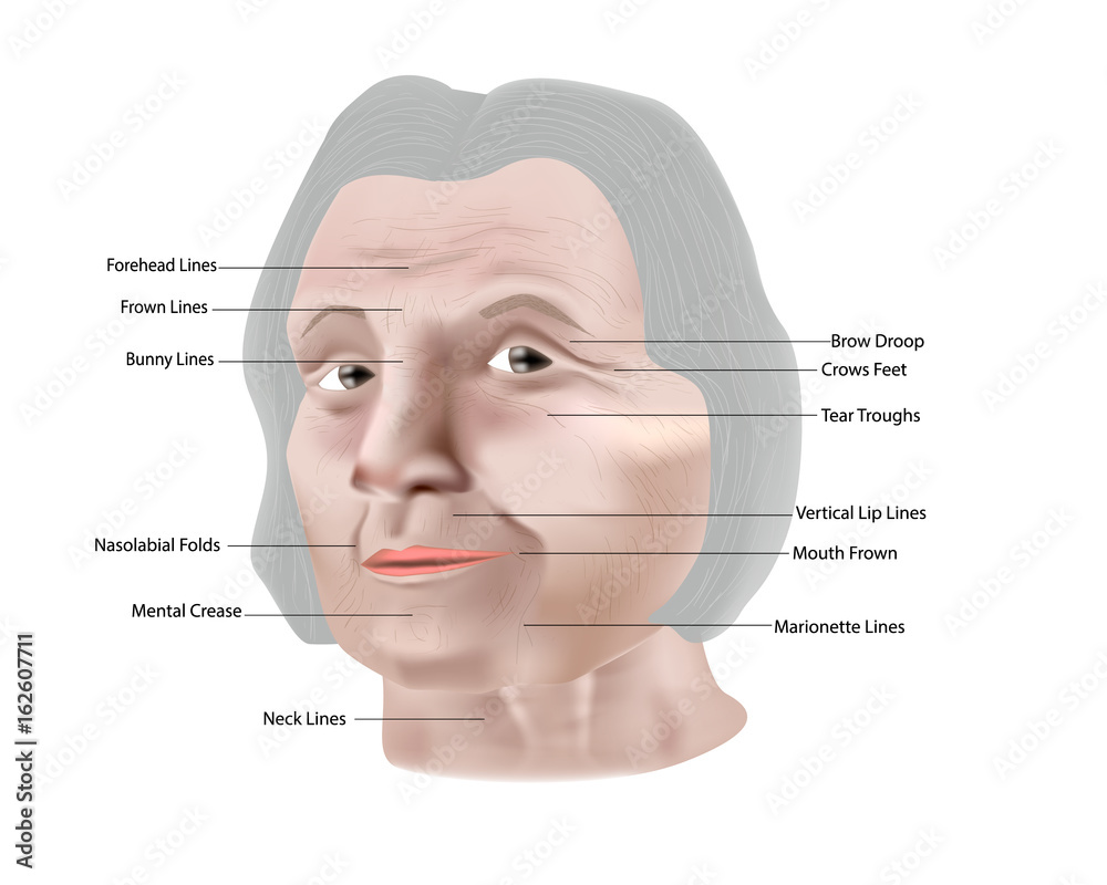 Types of facial wrinkles. Stock Vector | Adobe Stock