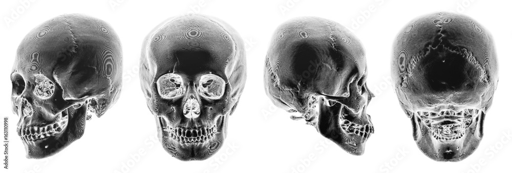 3D CT scan of human skull . Multiple view . Invert color style . Stock ...