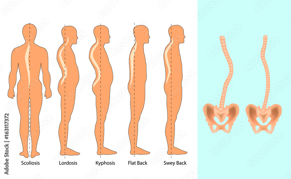Spine deformation. Body posture defect. Stock Vector | Adobe Stock