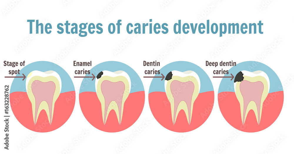 Caries Stages