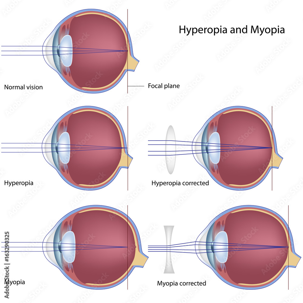 Myopia and hyperopia Stock Illustration | Adobe Stock