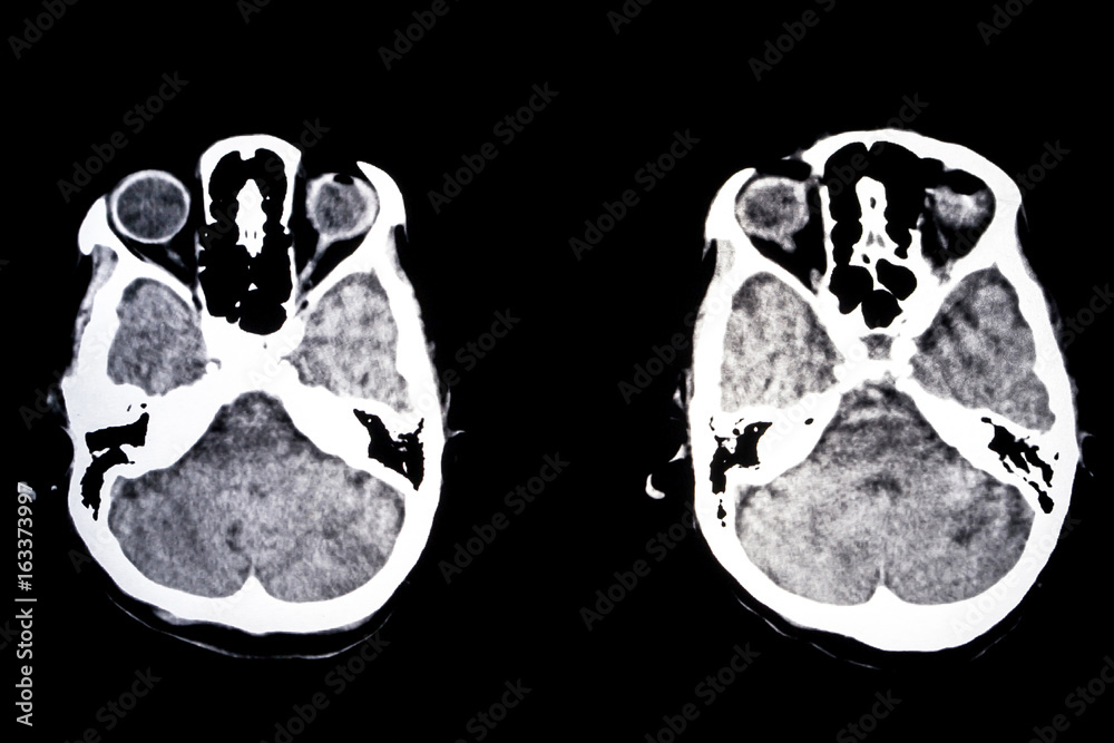 images from computed tomography (CT scan) of the brain Stock Photo ...
