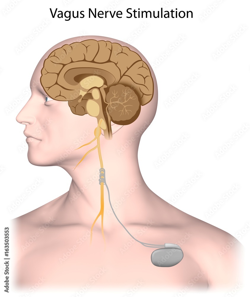 Vagus Nerve Stimulation Epilepsy Treatment (PDF) Vagus Nerve