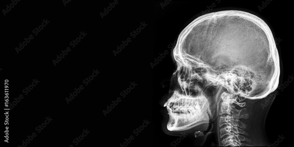 x ray of human head Stock Photo | Adobe Stock