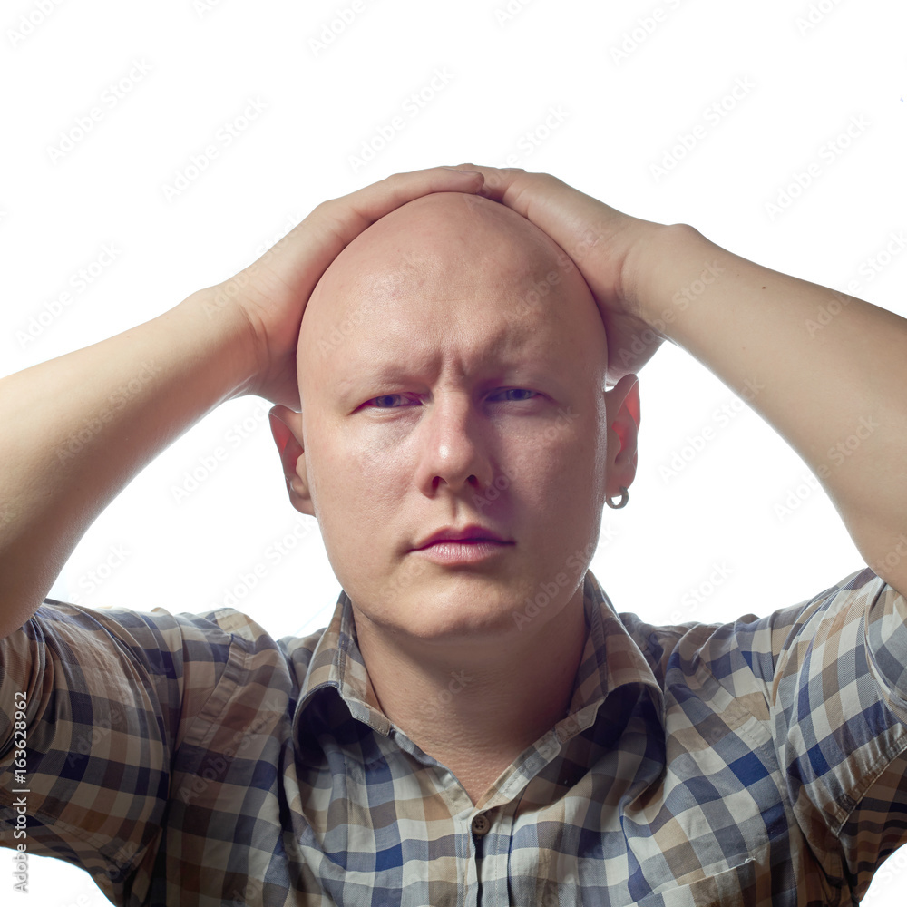 Autoimmune total alopecia men portrait. Absolute bald head without ...