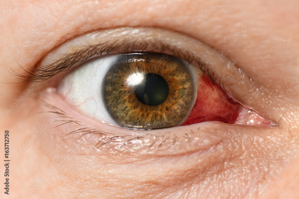 Subconjunctival hemorrhage - hyposphagma. Closeup of woman's red ...