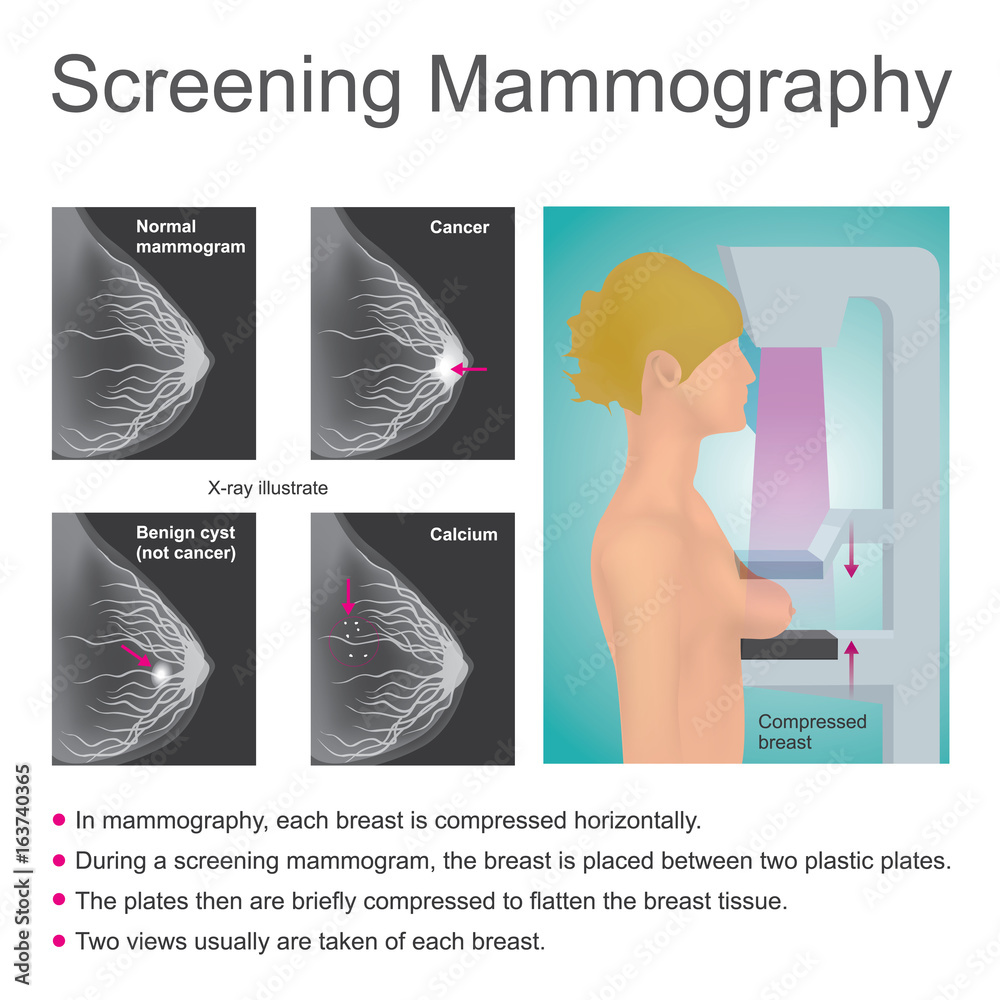 Mammography is the process of using low energy X-rays to examine the woman breast for diagnosis ...
