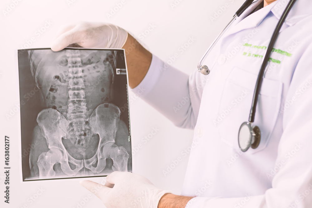 X-ray image of LS spine, AP view, show ankylosing spondylitis lumbar ...