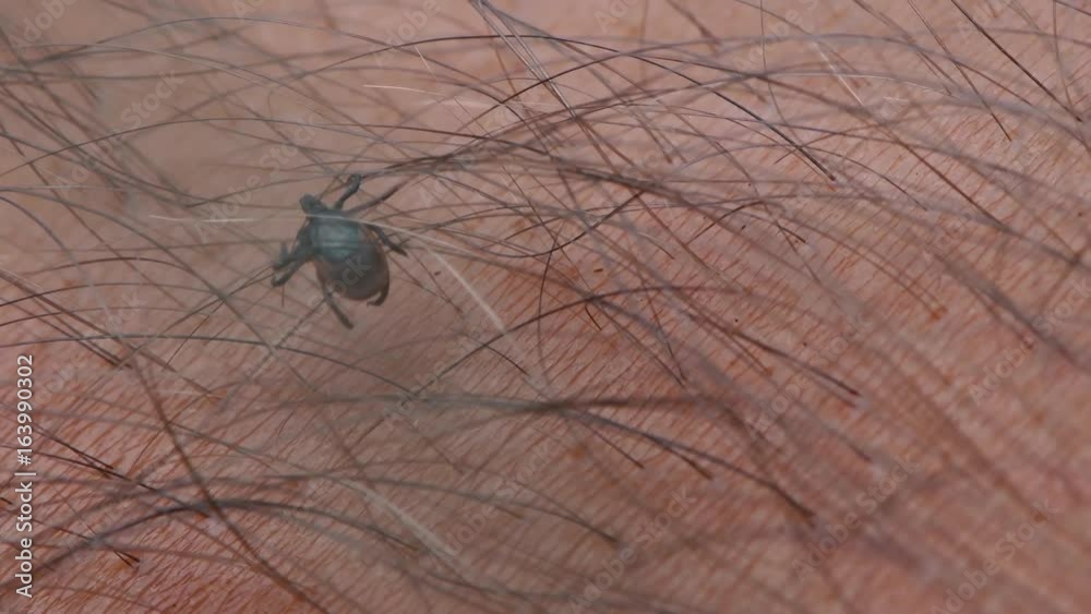 Tick crawling on person's arm. A mature sheep tick (Ixodes ricinus ...