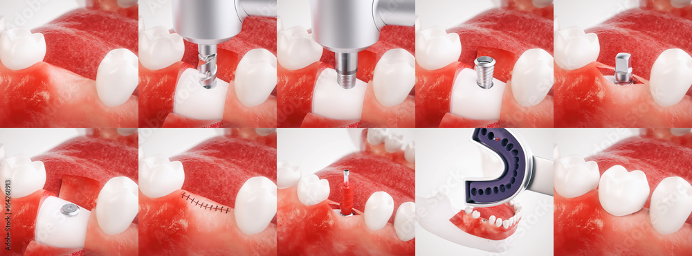 Dental implant operation - 3D rendering In this sequence of an implant ...