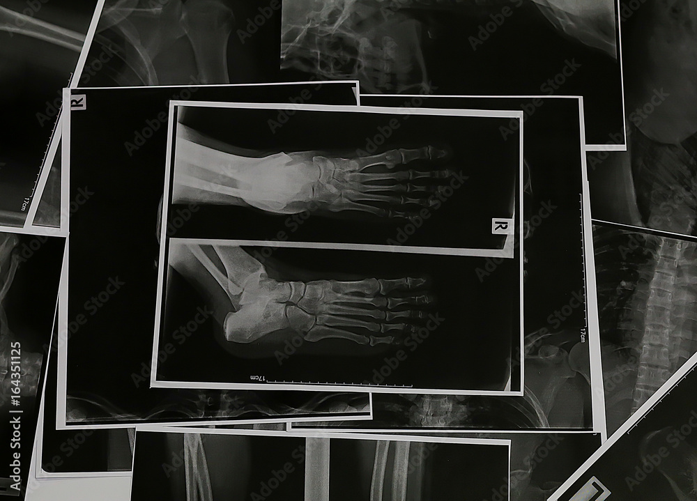 Xray right foot.X-ray foot collection show bone deformity in lateral ...
