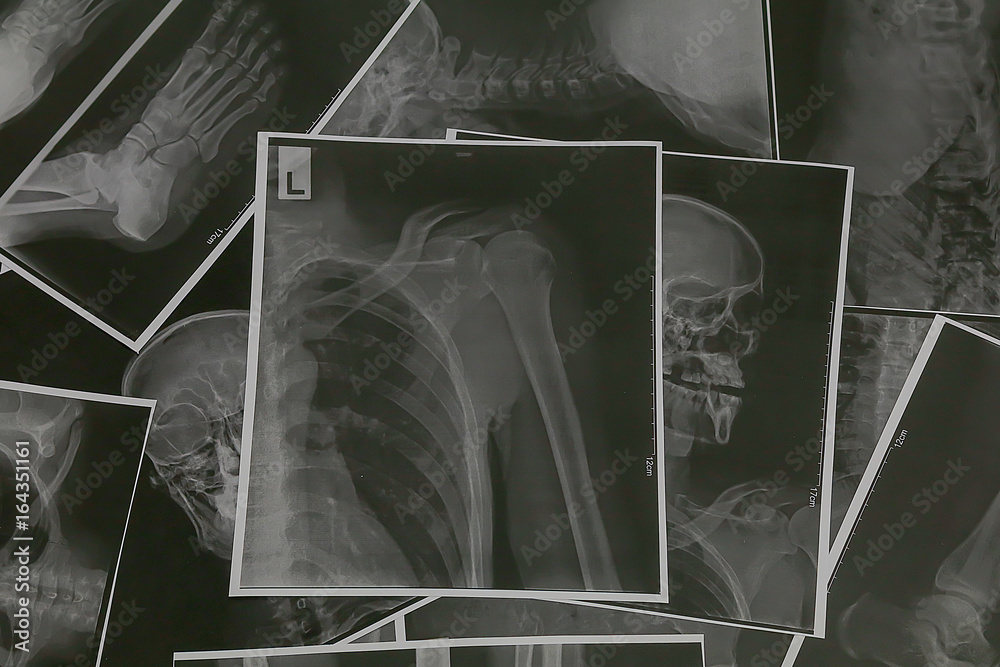 X-Ray Image of Human Chest for a medical diagnosis.Chest and lungs Xray ...