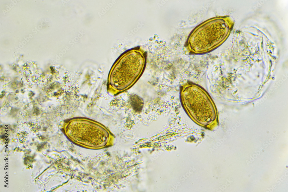 Eggs of Trichuris trichiura (whipworm) in stool, analyze by microscope ...