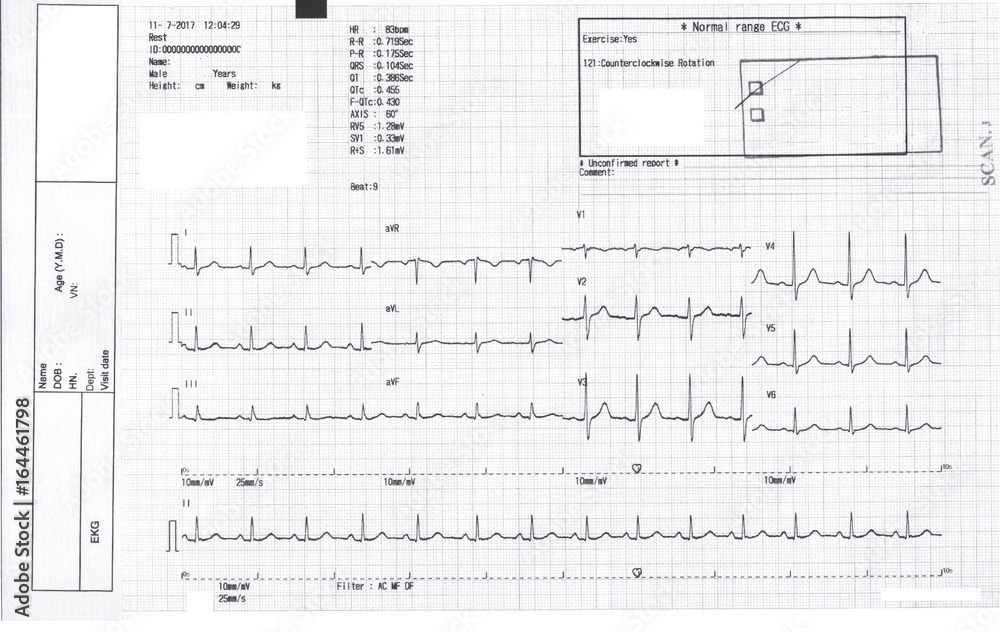 EKG, ecg graph, Electrocardiogram ecg on paper Stock Photo | Adobe Stock