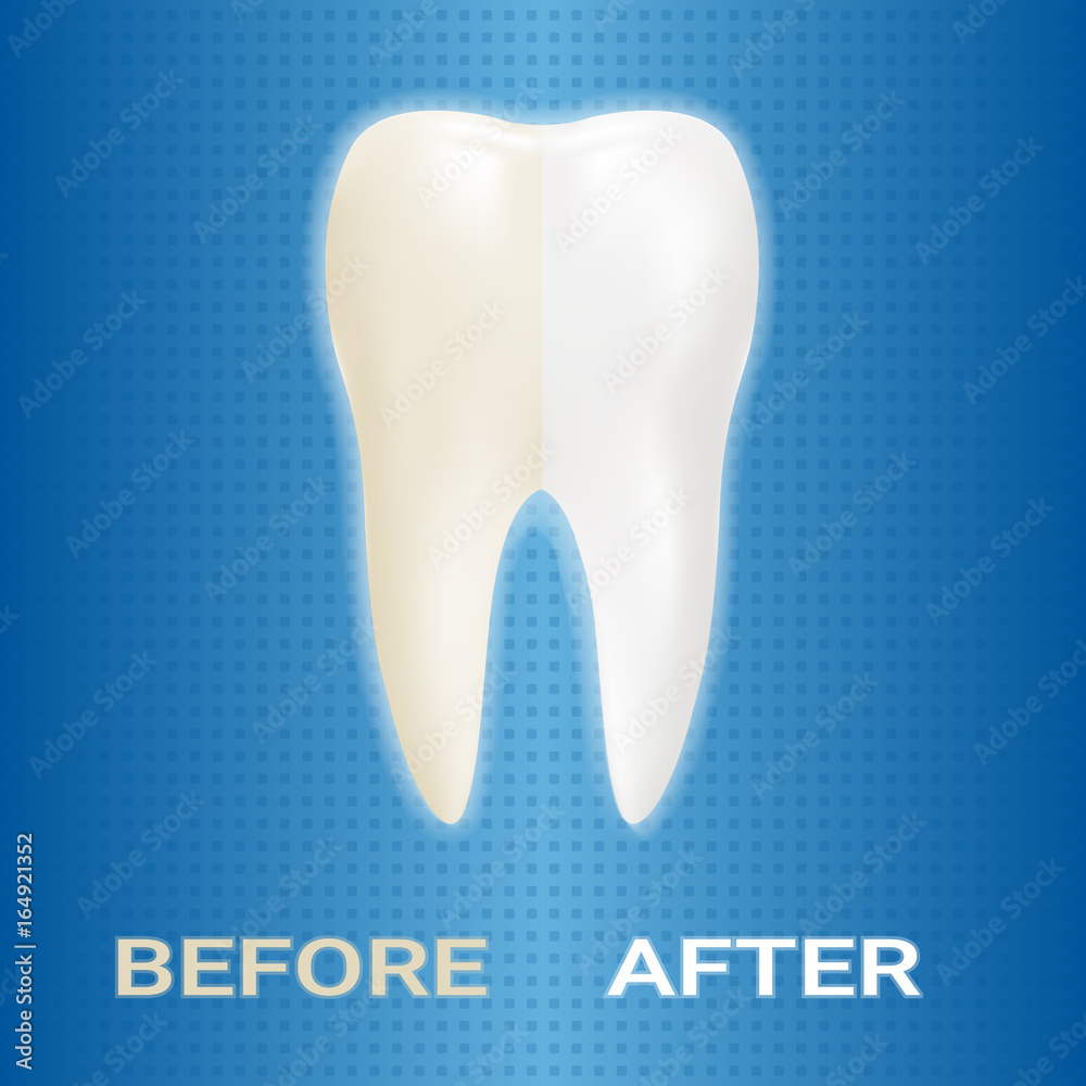 Dental Veneer, Whitening Of Human Tooth, Whitening Toothpaste Isolated ...