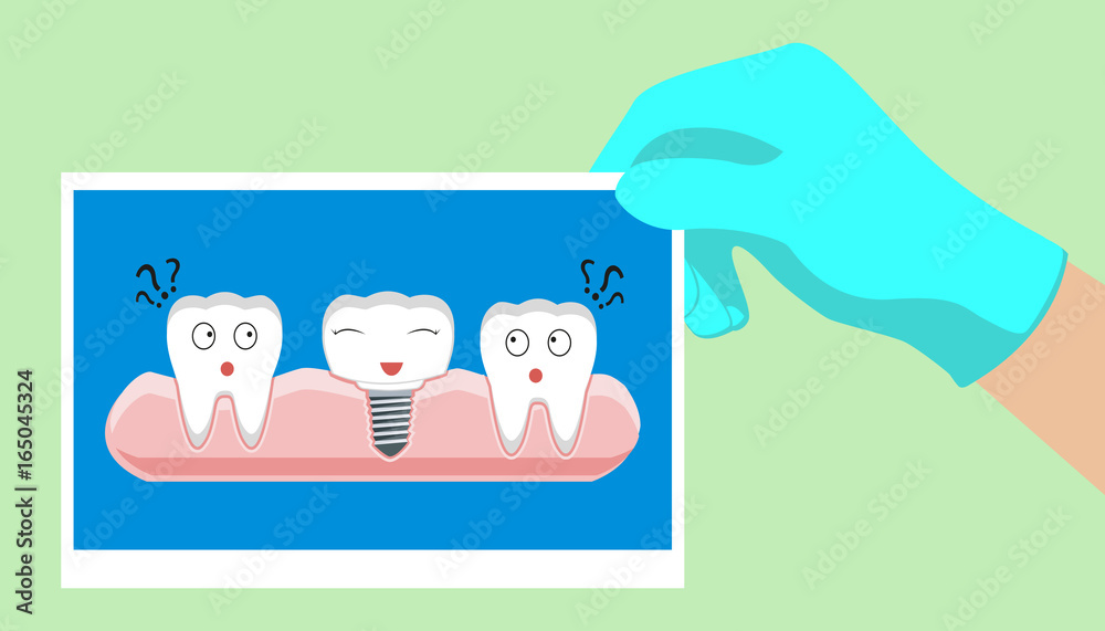Cartoon dental implant and teeth. Smiling teeth and dental implant ...