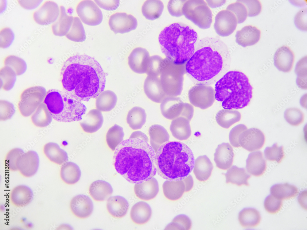 Leukemia cells in blood smear, analyze by microscope Stock Photo ...
