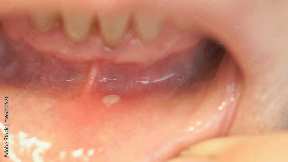 Disease in the mouth. Stomatitis into mouth on the lower lip. Close-up ...