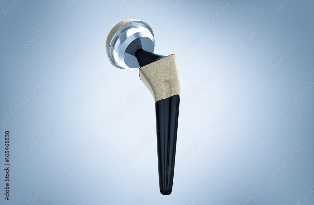 Hip replacement implant isolated Stock Illustration | Adobe Stock