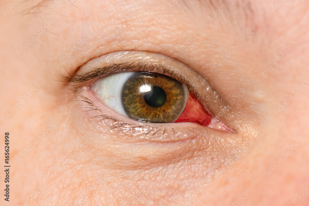Subconjunctival hemorrhage - hyposphagma. Closeup of woman's red ...