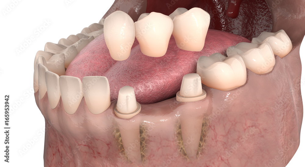 Dental anatomy - Lower teeth dental bridge with bone structure and ...