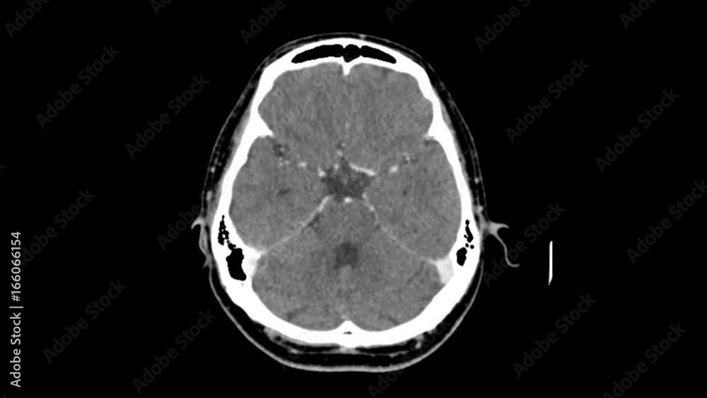 ct scan of upper brain of head top view smooth motion Stock Video ...