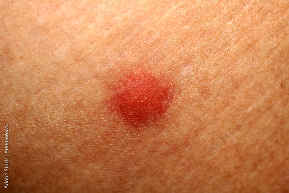 1238137 Red mosquito bites. Swelling of the skin. A bite of a wasp, a ...