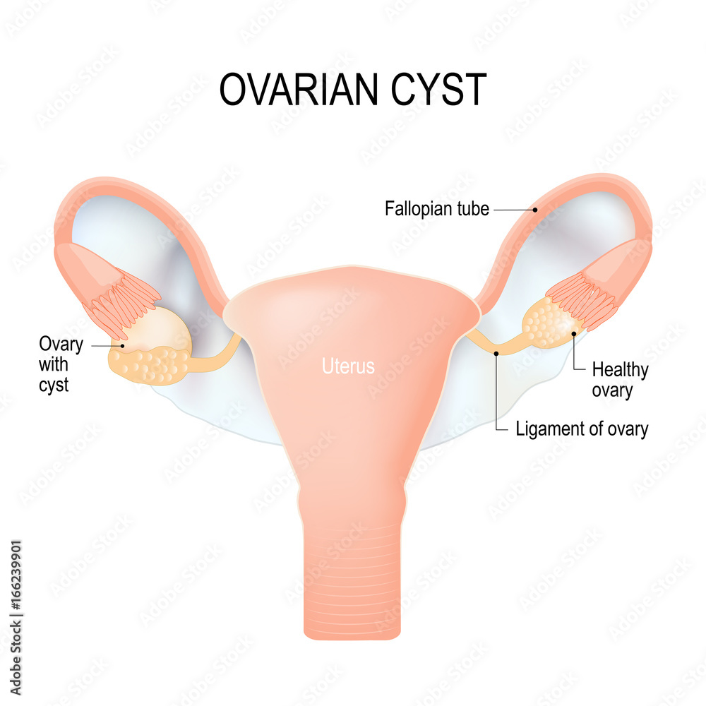 Ovarian Cyst Illustration An Ovarian Cyst Is A Fluid Filled Sac Porn Sex Picture