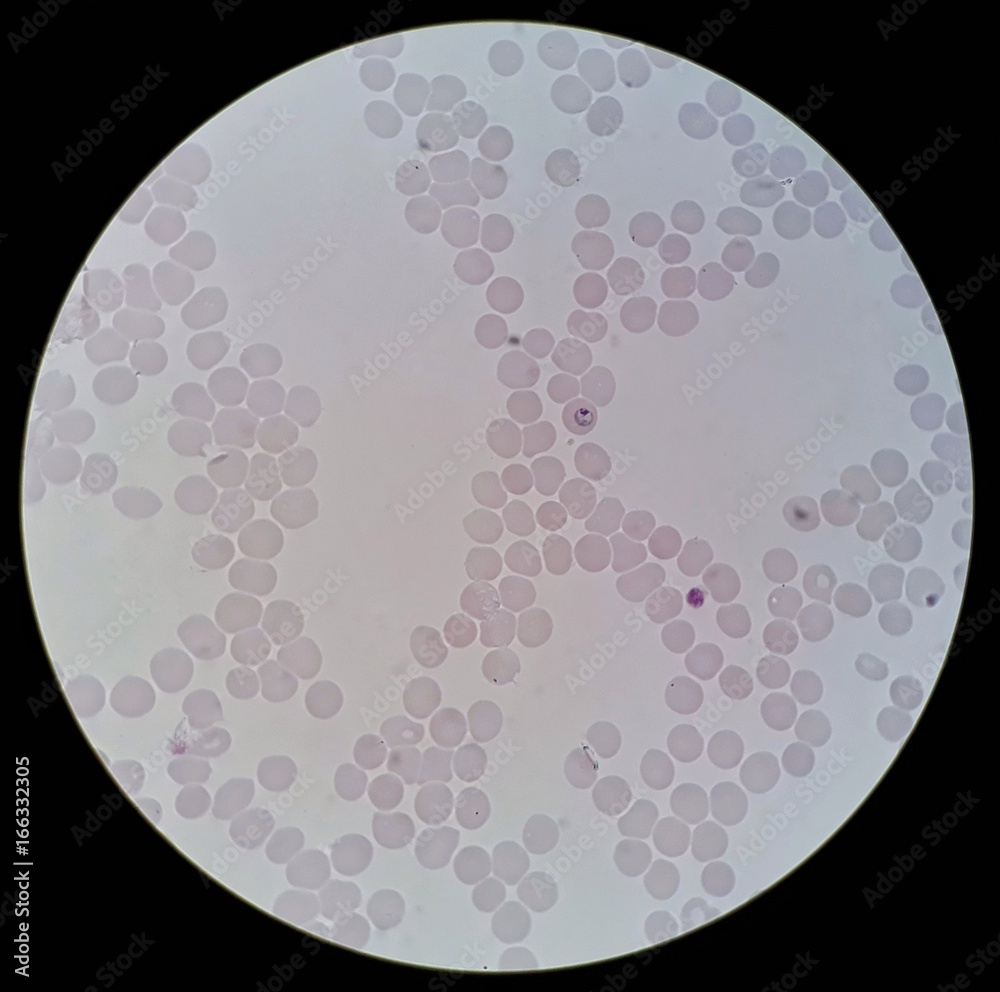 Under 100X light microscope, human parasite on thin film of blood smear ...