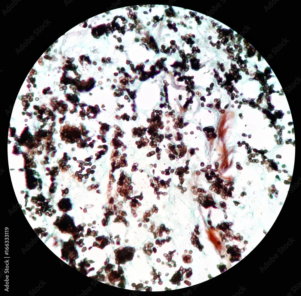 Smear from tissue biopsy Giemsa stained under 100X light microscope ...