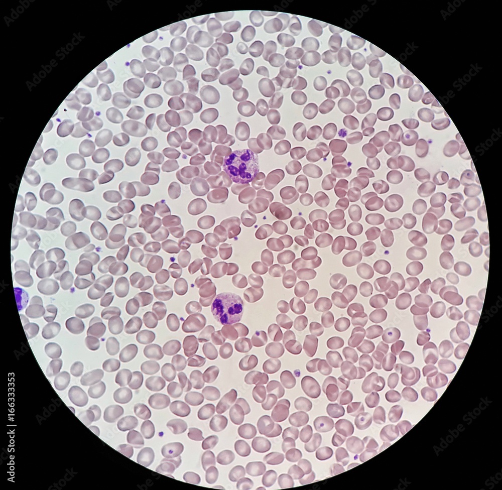 Human blood smear with abnormal red blood cells morphology call ...