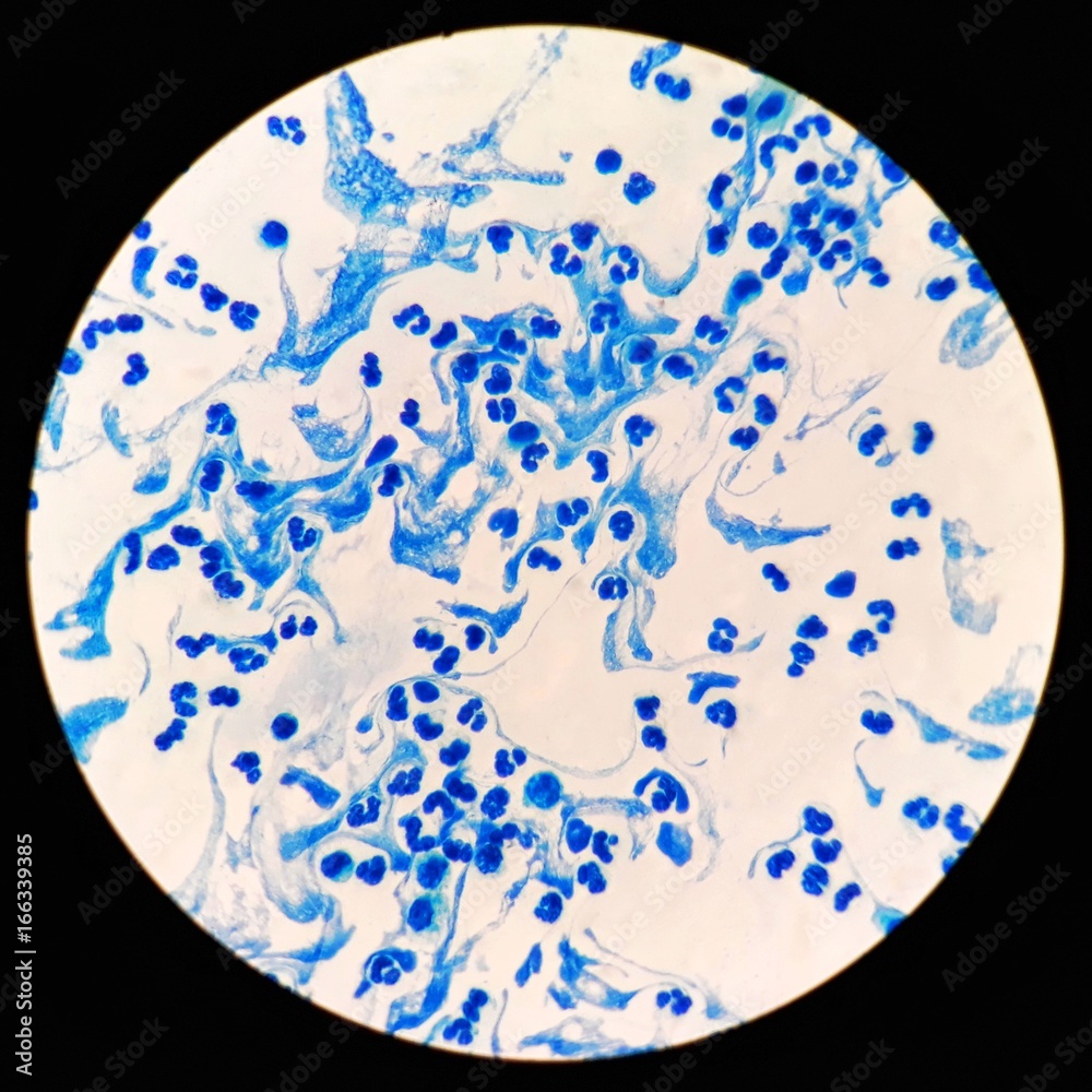 Smear of Acid-Fast bacilli (AFB) stained from sputum specimen with ...